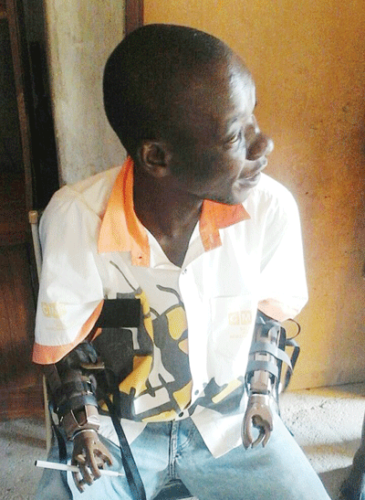 Artificial arms offer xenophobia victim hope -Newsday Zimbabwe